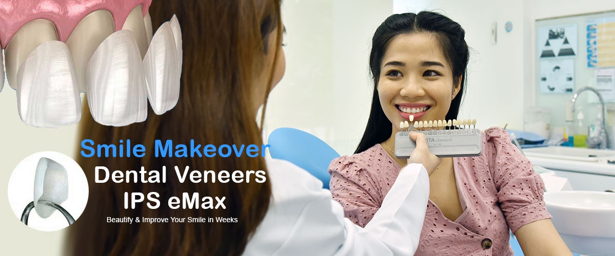 Veneers transforms smiles by dental makeovers