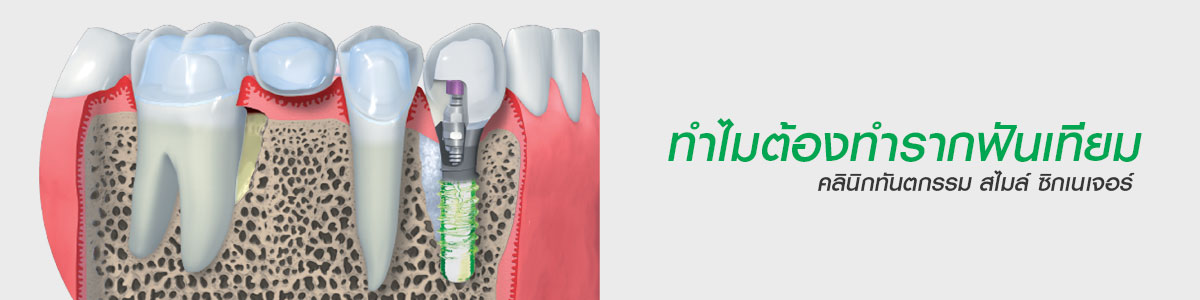 Dental Implants at Smile Signature Dental Clinic