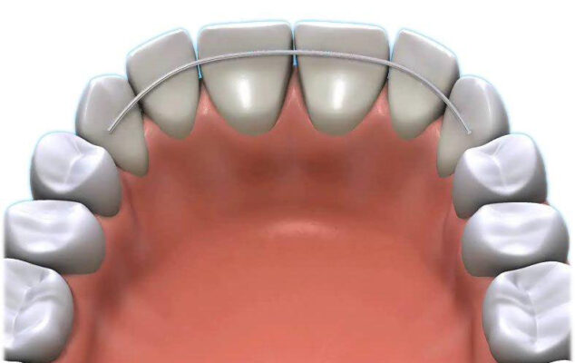 Retainers - Removable and fixed appliances