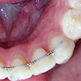 เคล็ดลับการดูแลรักษาและทำความสะอาด รีเทนเนอร์ (Retainer)